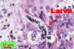 Angiostrongyliasis - Microscopy Findings