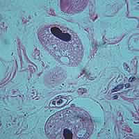 Balantidiasis - Microscopy Findings