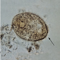 Balantidiasis - Microscopy Findings