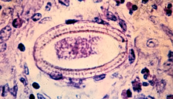 Capillariasis - Microscopy Findings
