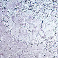 Capillariasis - Microscopy Findings