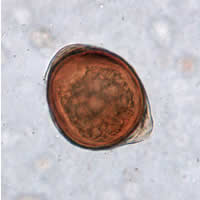 Trichuriasis - Microscopy Findings