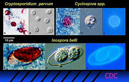 Cyclosporiasis - Microscopy Findings